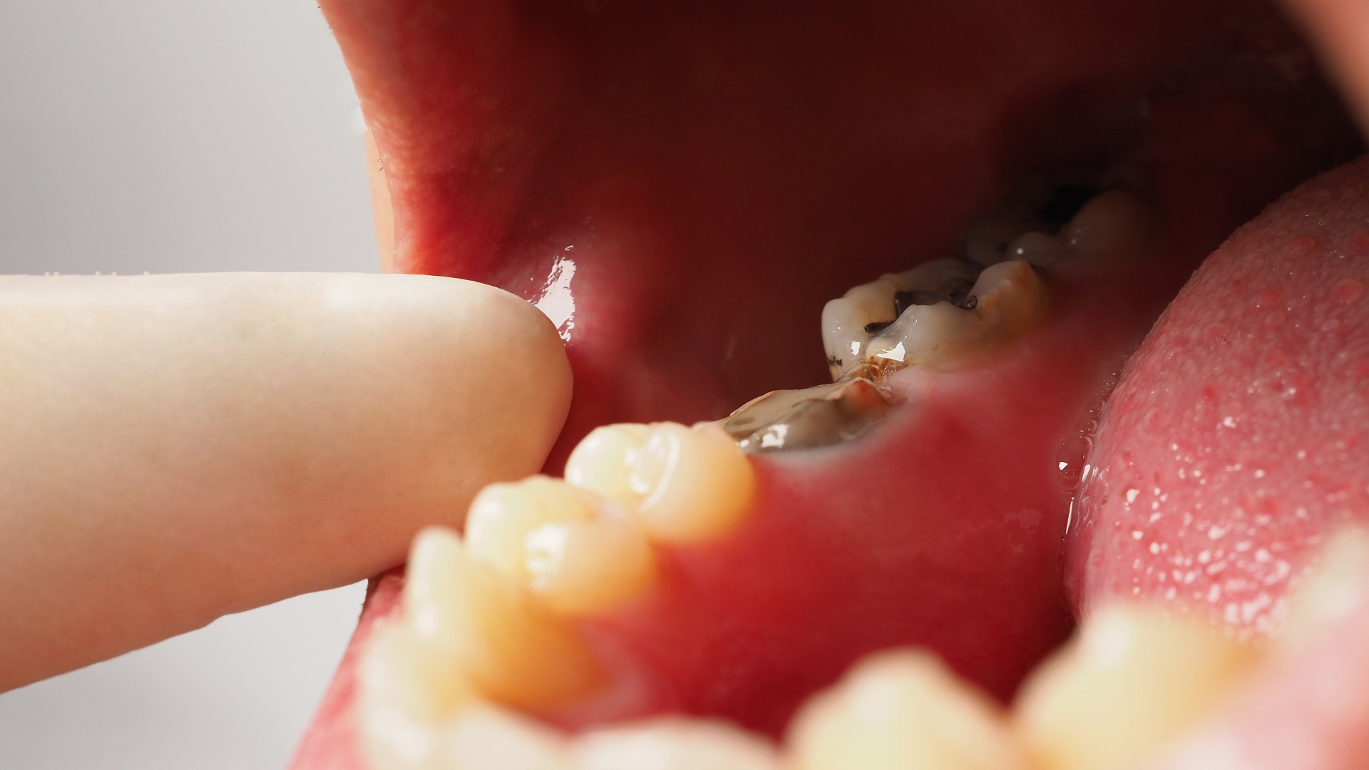 Cosmetic Dentistry for Tooth Decay in Shanghai with PureSmile